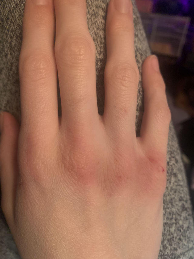 Tips for hand dermatitis/ flare-ups | Skin Concern