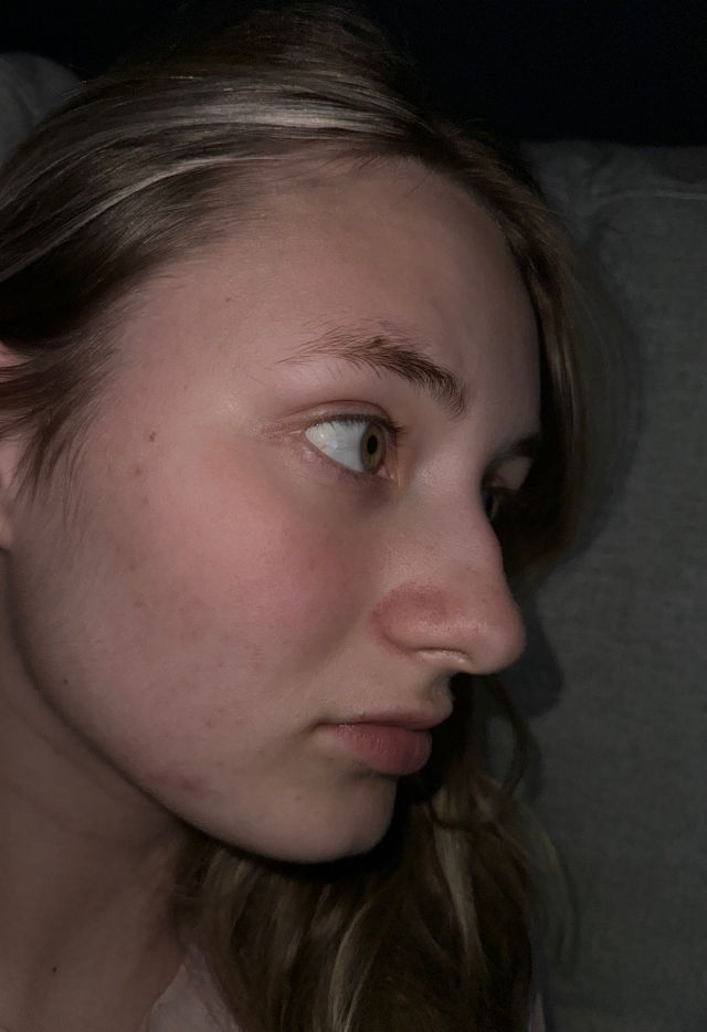 PIE/ redness around nose | Skin Concern