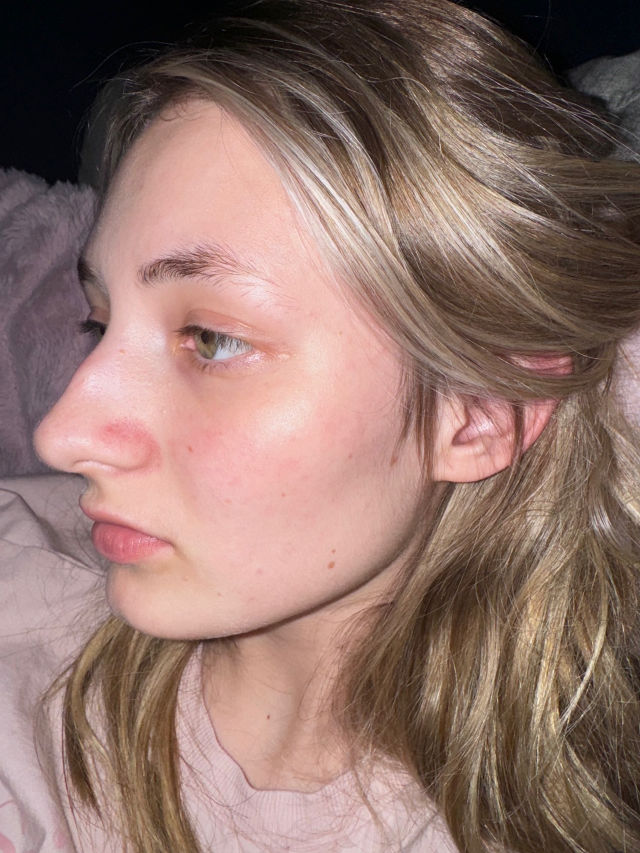 PIE/ redness around nose | Skin Concern