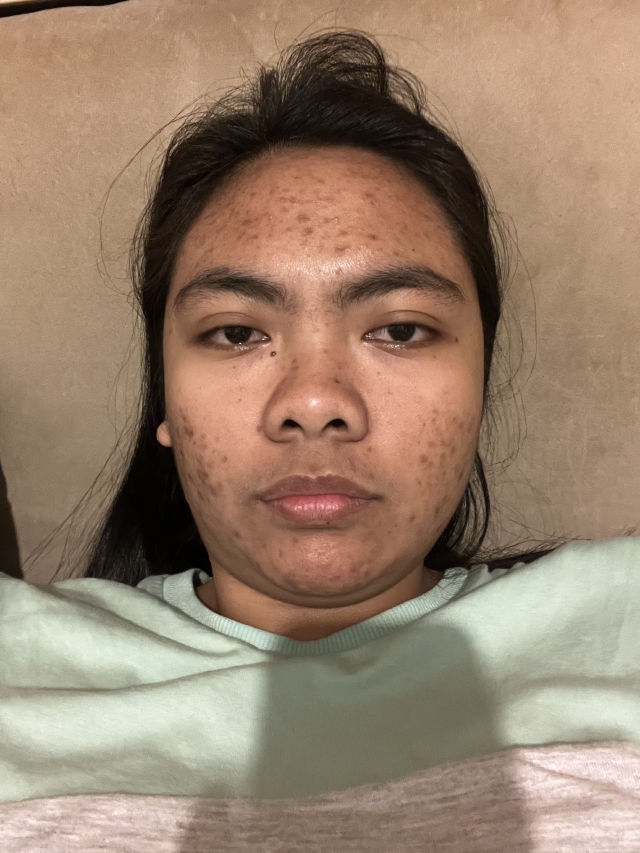 shellbyy | Routine / Fungal Acne / Hyperpigmentation
