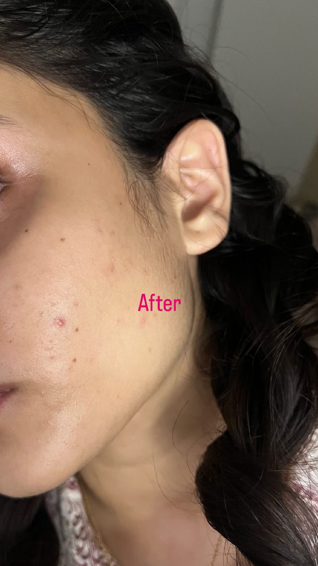 How I Cleared My Closed Comedones! | Skin Concern