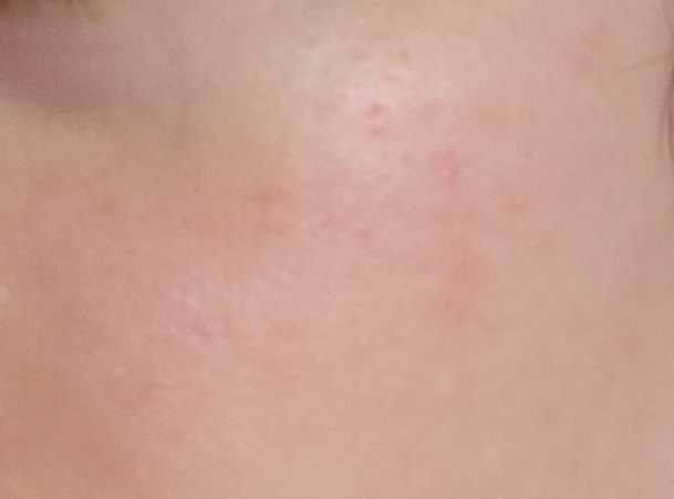 Red little bumps on the cheeks | Skin Concern