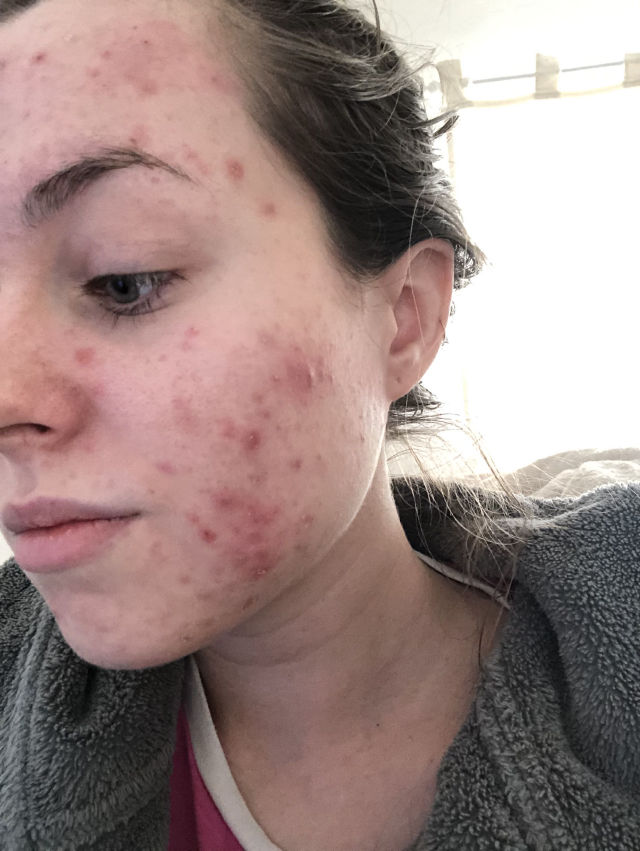 Galderma Epiduo Gel Pump Reviews & Ingredients