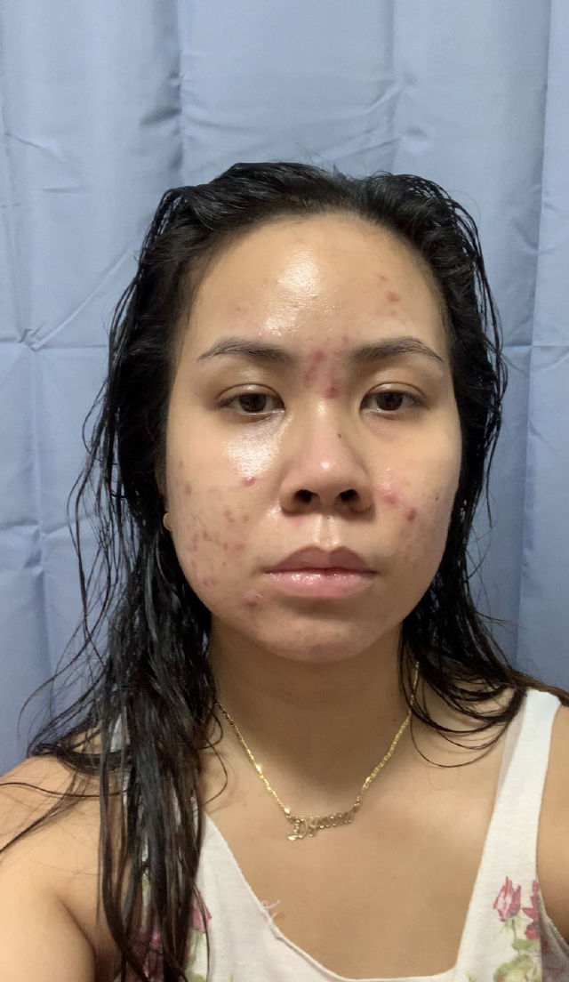 Galderma Epiduo Gel Pump Reviews & Ingredients